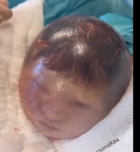 Rare Case: Baby Born Holding an IUD Device - News